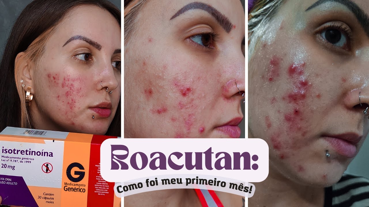 DIÁRIO DA ACNE - ISOTRETINOÍNA (ROACUTAN) 1º MES: EFEITOS COLATERAIS ...