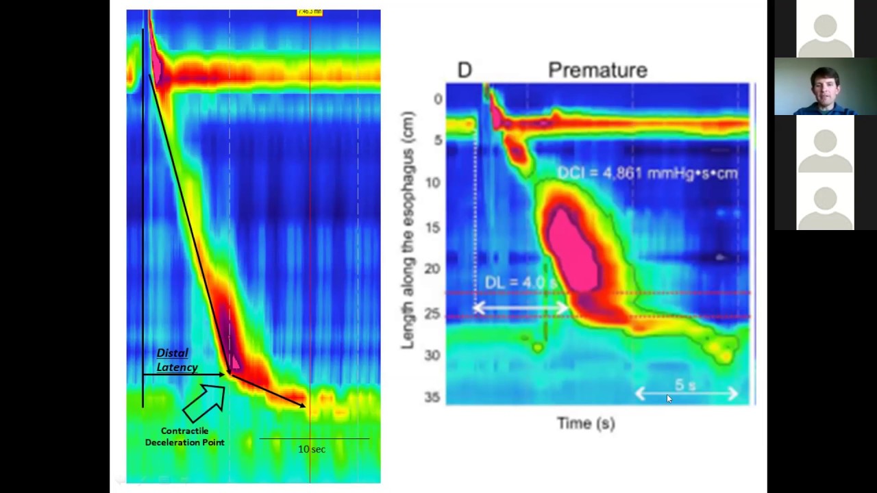 Diffuse Esophageal Spasm Manometry