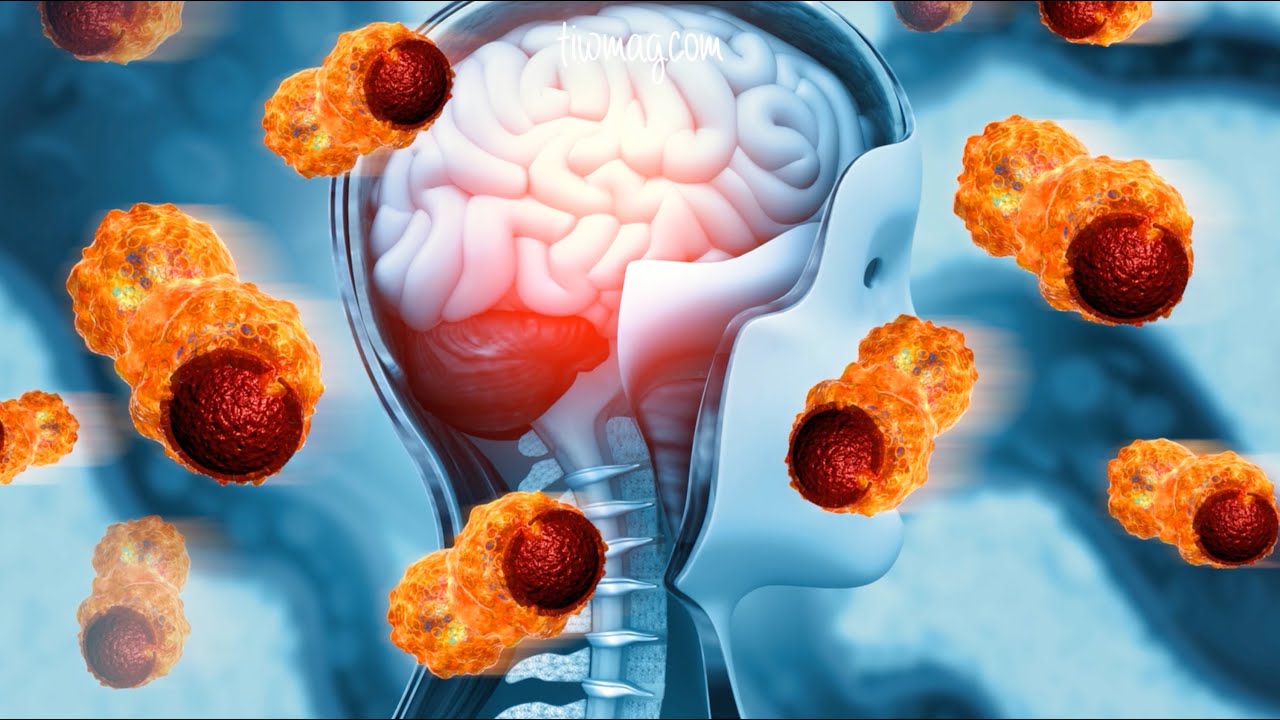 Multiple Sclerosis: Why Women are More at Risk - YouTube