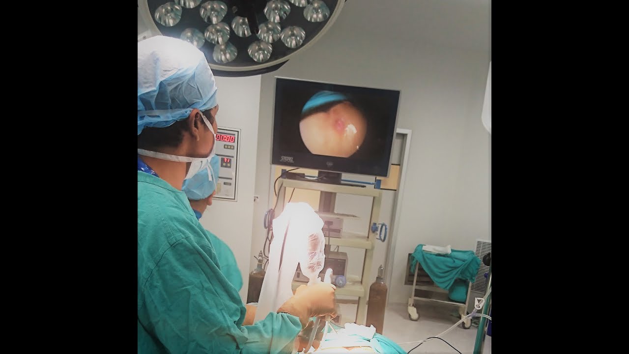 EPSiT- BEST Treatment For Pilonidal Sinus Dr SANJAY CHAUREY Dr PRASHANT ...