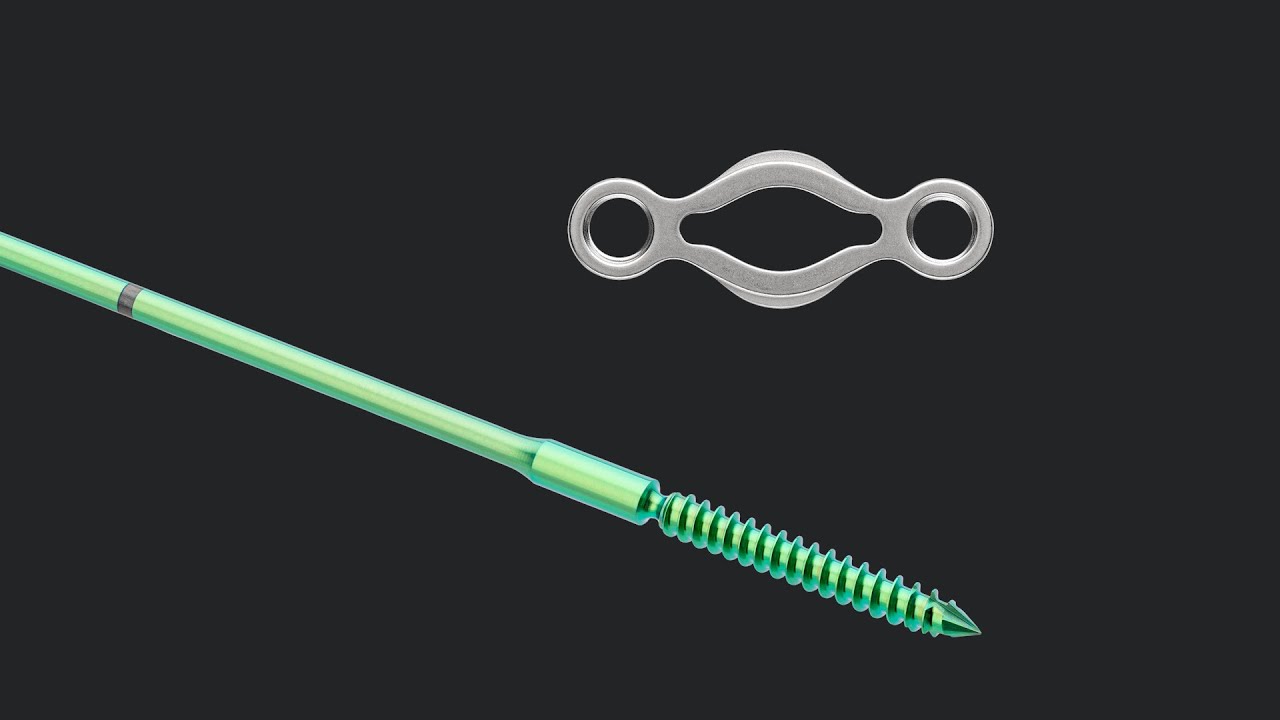 Snap-Off Compression FT Pins - Midfoot Arthrodesis (Dr. Horton) - YouTube