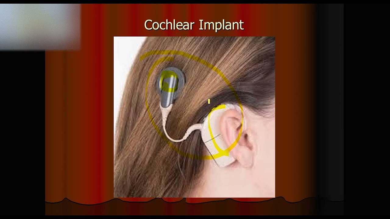 Dr. H - Audiology - (7) - Cochlear Implant - how it works - YouTube