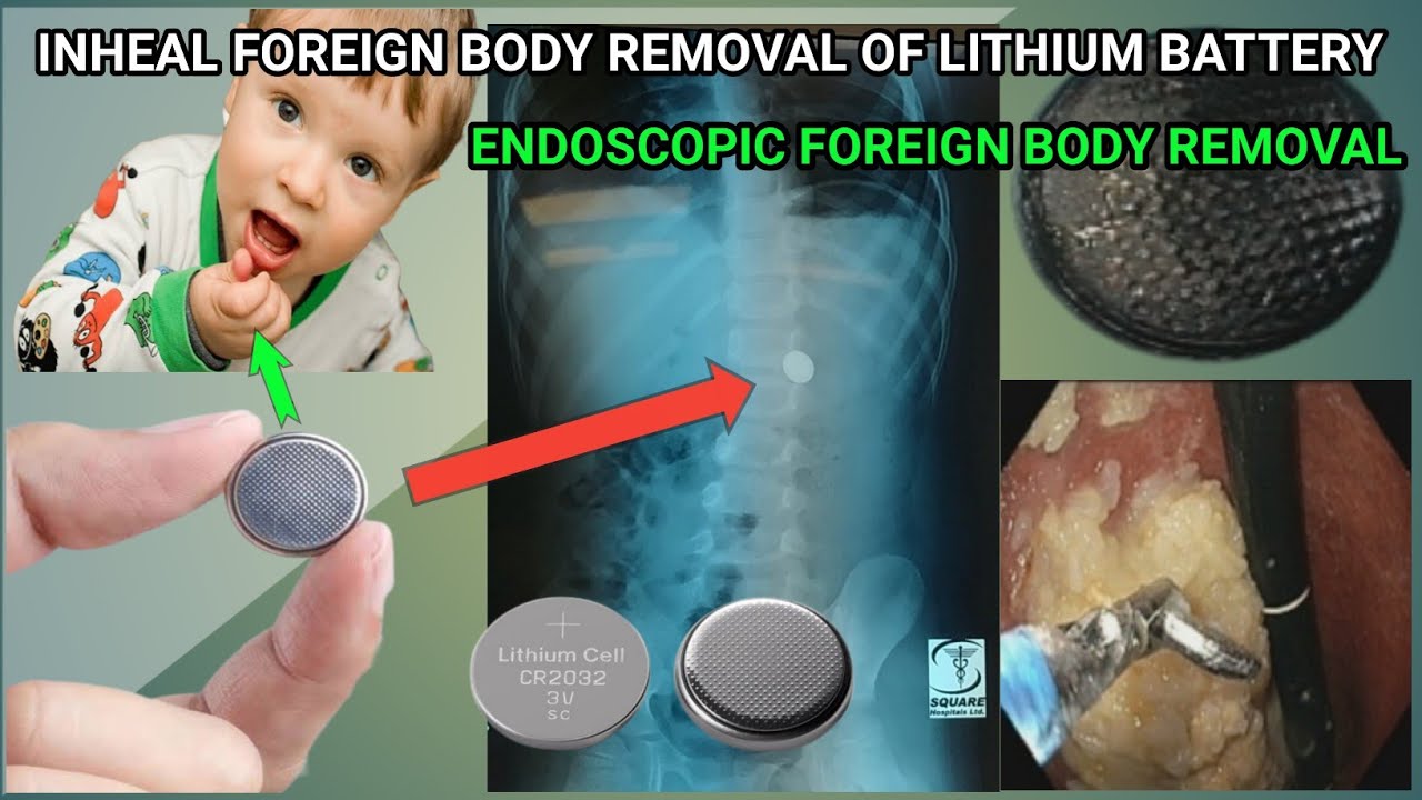 Endoscopic Foreign Body Removal of Lithium Battery at SQUARE HOSPITALS ...
