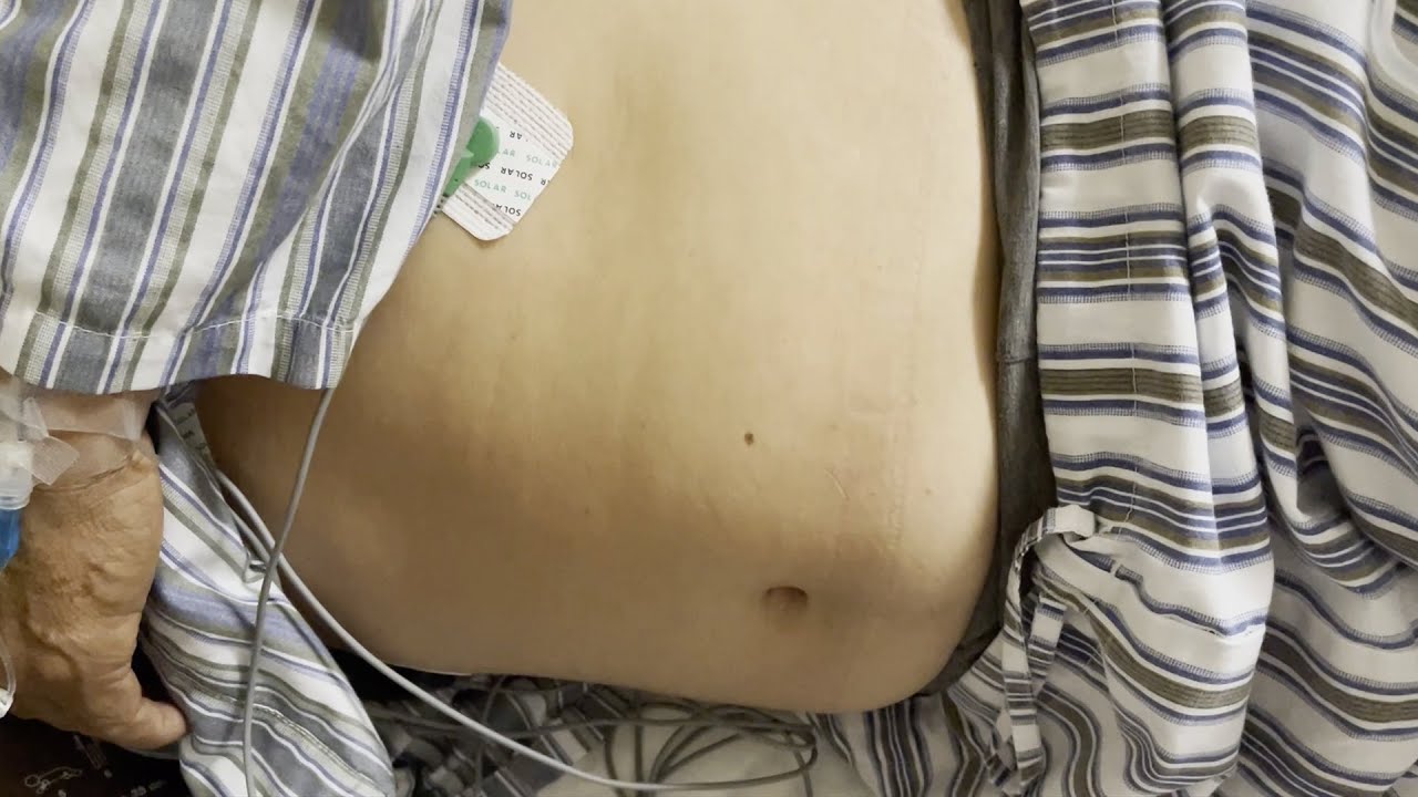 Involuntary Abdominal Contractions in Belly Dancer’s Dyskinesia ...