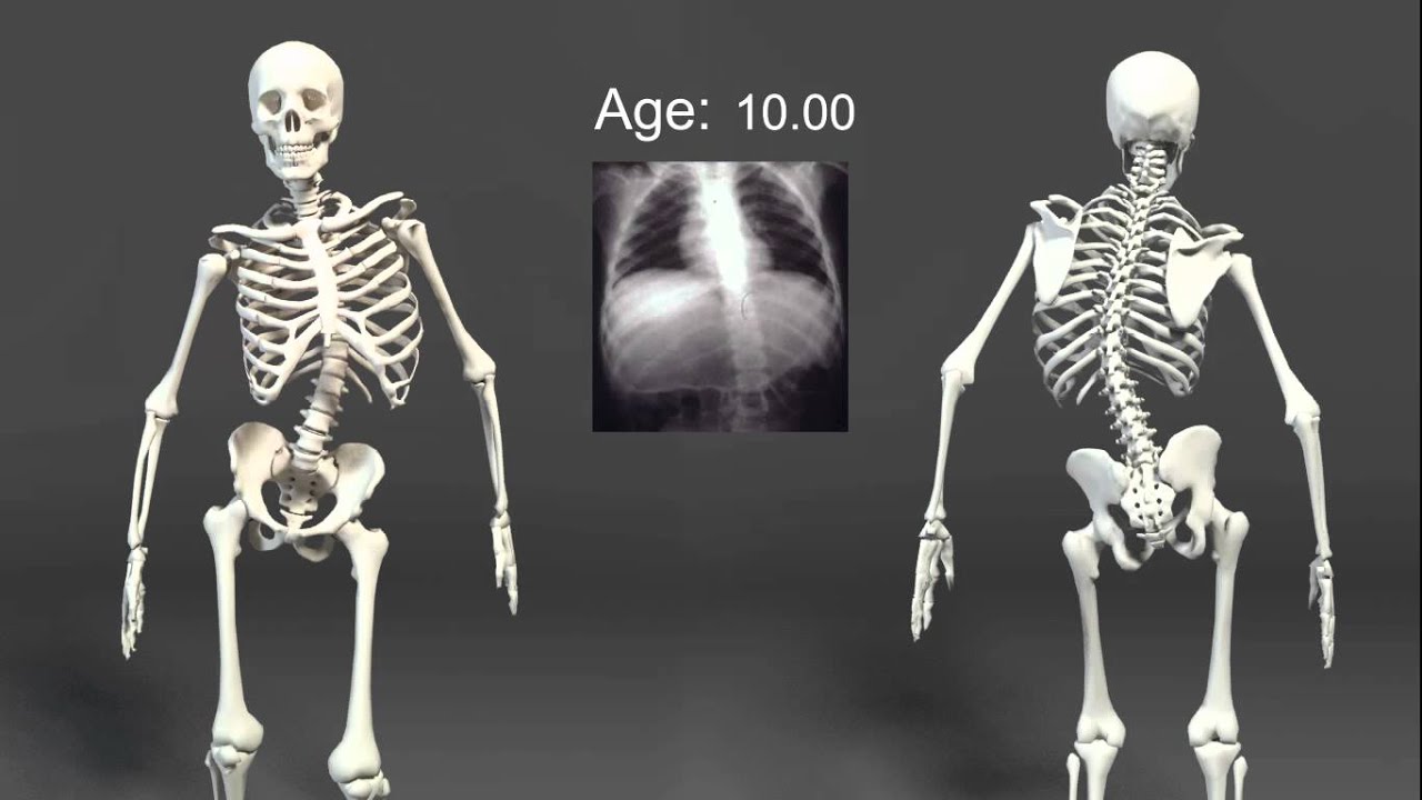 3D Scoliosis Animation - YouTube