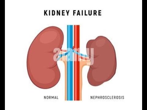 Benign Nephrosclerosis and Malignant Nephrosclerosis ; Definition ...