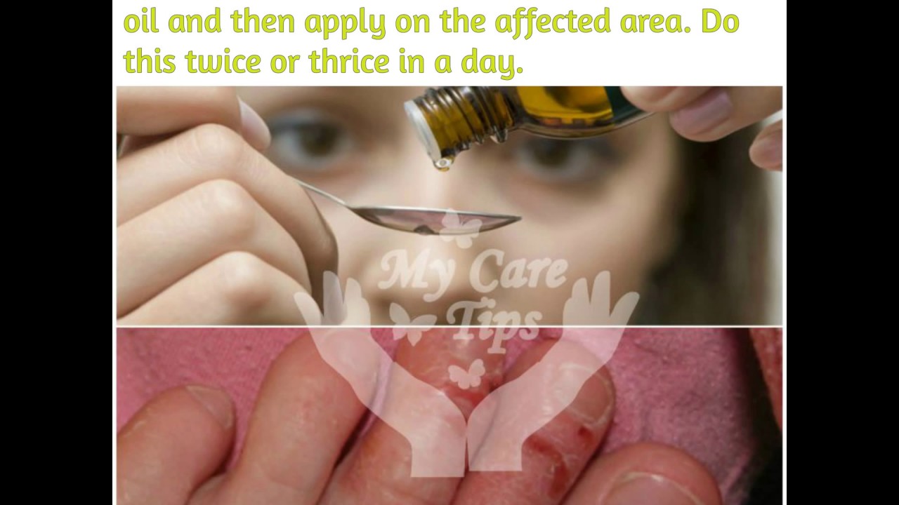 Natural Skin Fungus Treatment In Urdu YouTube natural-skin-fungus-treatment-in-urdu-youtube