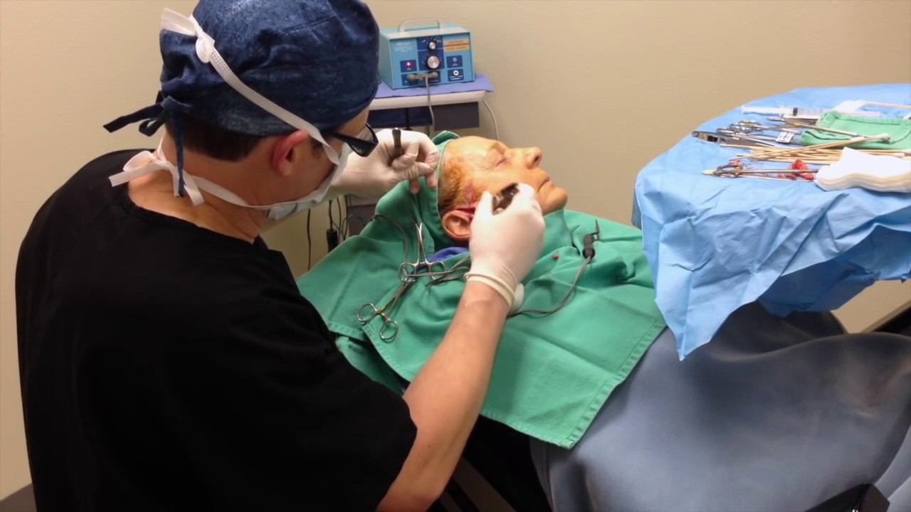 Mini Incision Facelift & dermal filler by Dr. Burroughs from Springs ...