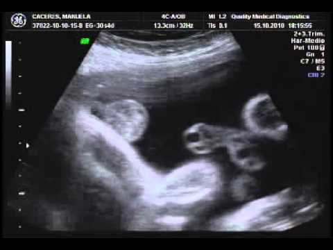 ECOGRAFIA KENNETH ORDOÑEZ CACERES PARTE 3 - YouTube