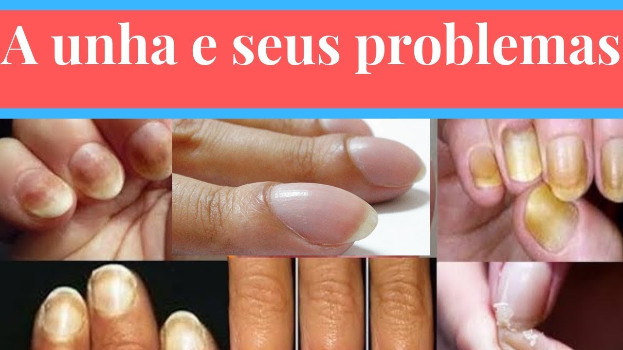 🌿 UNHAS. Os problemas nas unhas podem significar doenças mais sérias ...