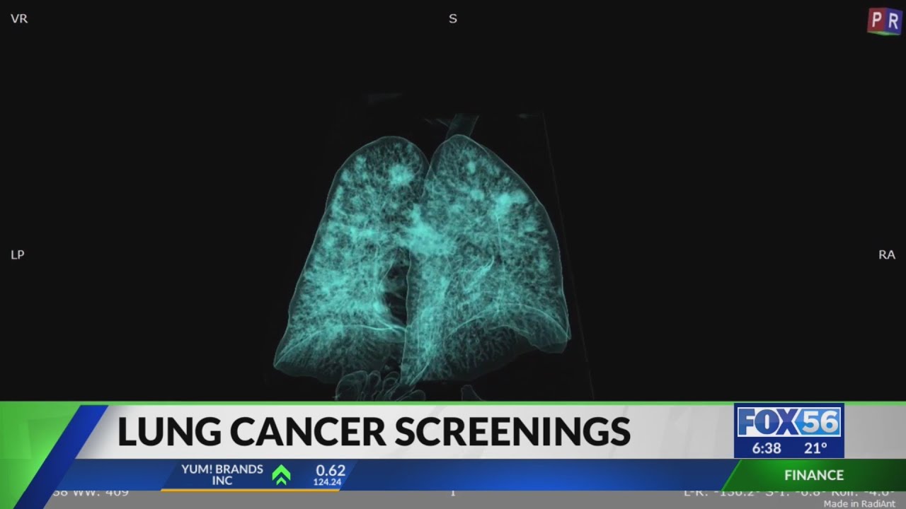 Bill would help those in need of a lung cancer screening - YouTube