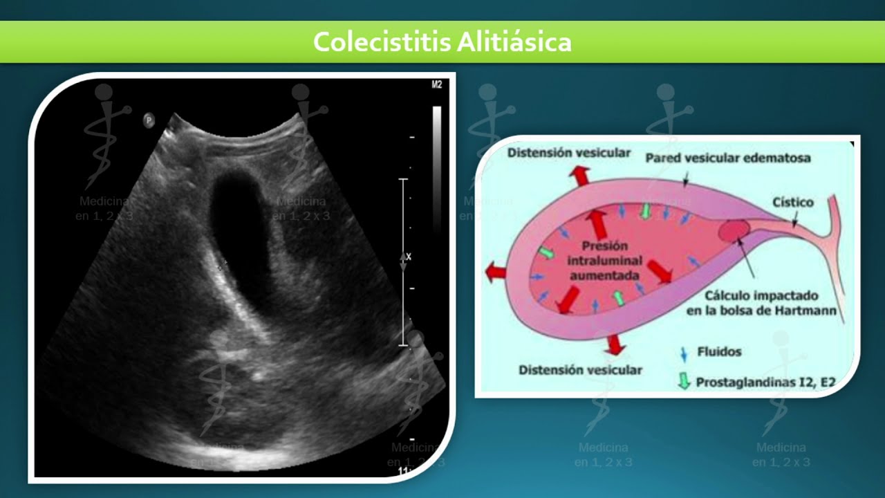 Vesícula Biliar En Bolsa De Hartmann