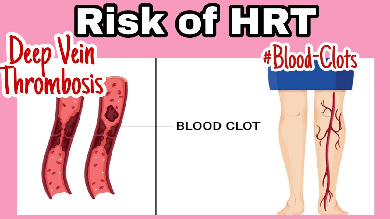 ONE OF THE RISKS OF HRT(Blood clotting and deep vein thrombosis!)💓 ...