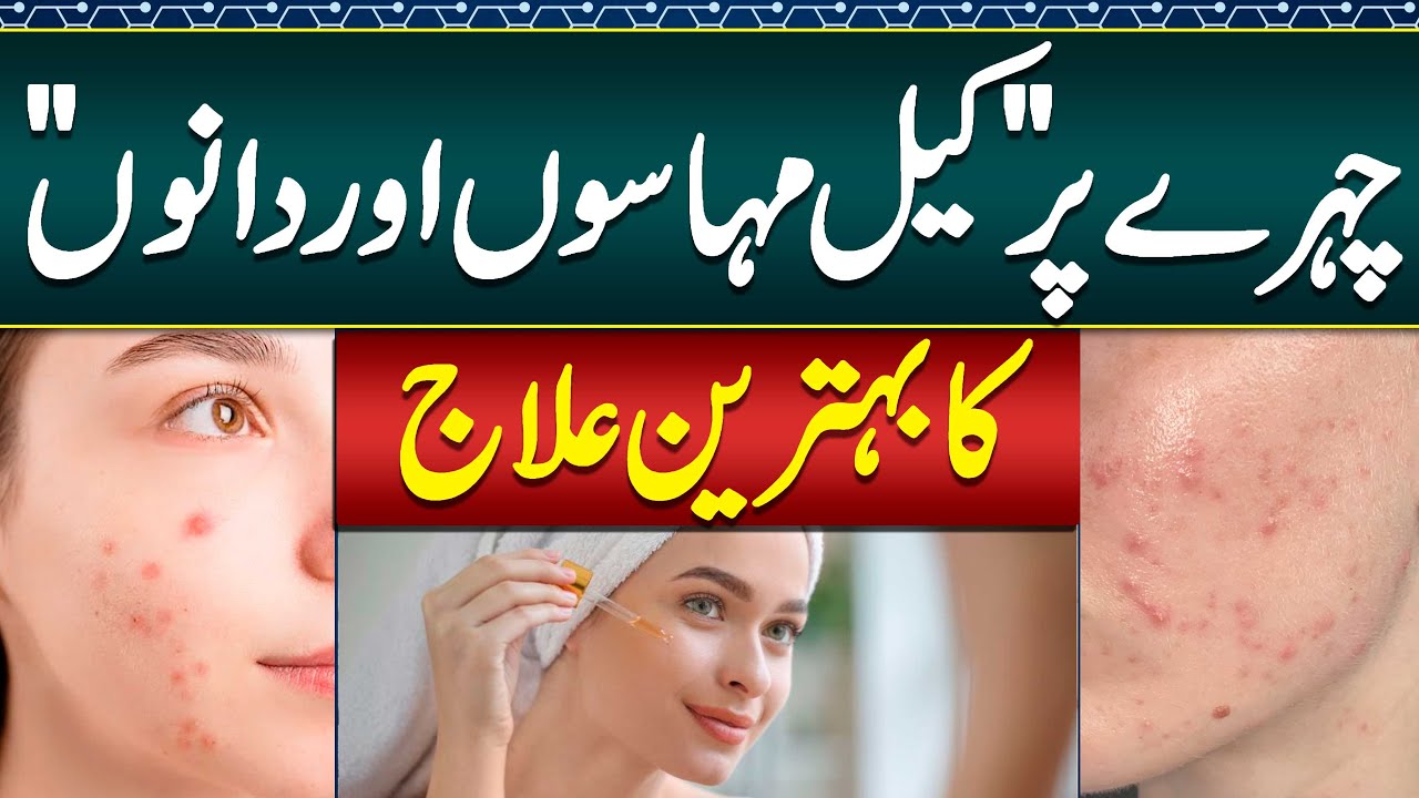 Acne Treatment - Acne Scars Treatment - Acne Marks Removal Treatment ...