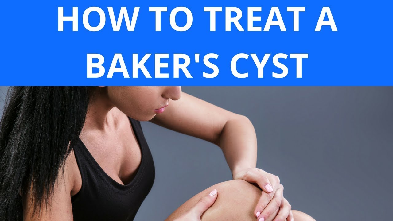 How To Treat A Baker s Cyst YouTube
