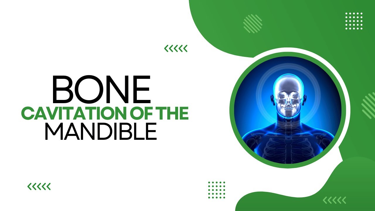 Bone Cavitation of the Mandible: Causes, Symptoms and Treatment - YouTube
