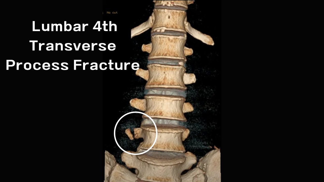 Closed Fracture Of Lumbar Vertebrae Saybets