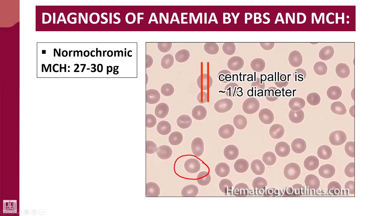 Hematology - 1 | U5-L6 | Morphological classification of anaemia by MCV ...