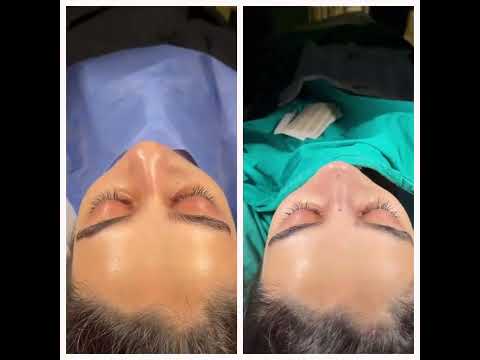 Burun estetiği değişimi #shorts #shortvideo #viral #viralvideo #video #trending #youtubeshorts #love