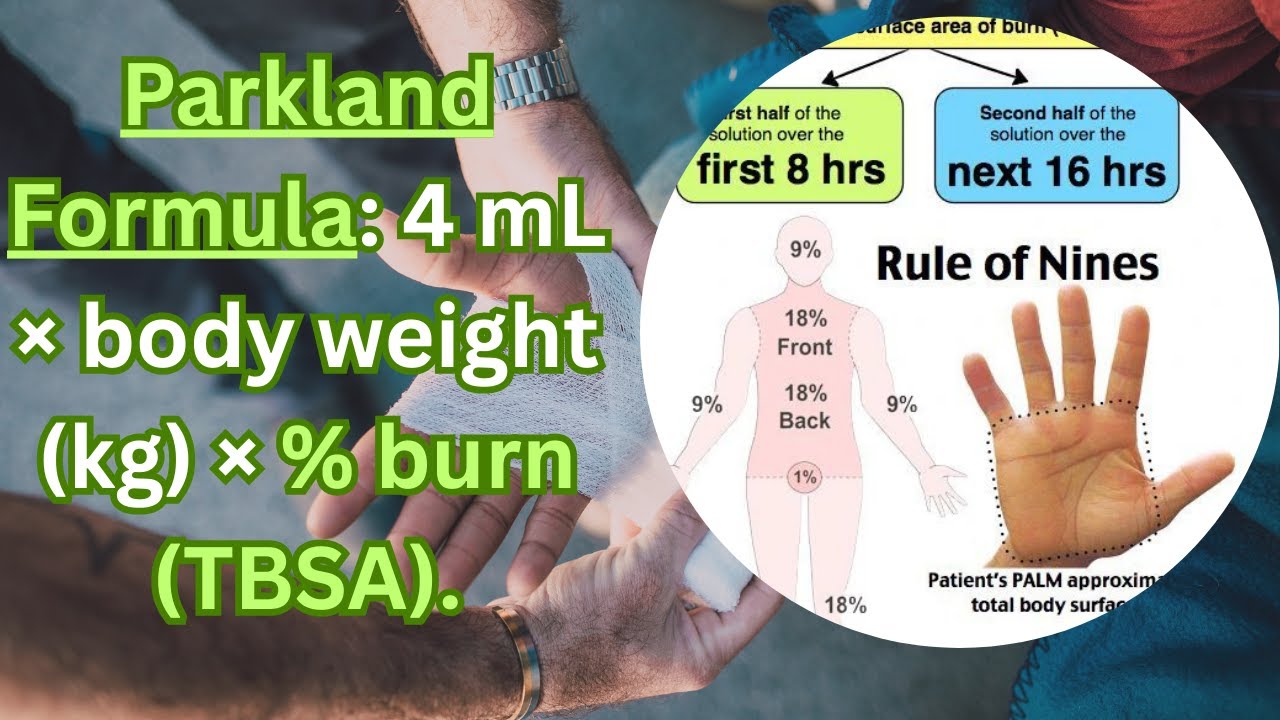 Burn Management : Parkland Formula & Rule of Nines Explained - YouTube