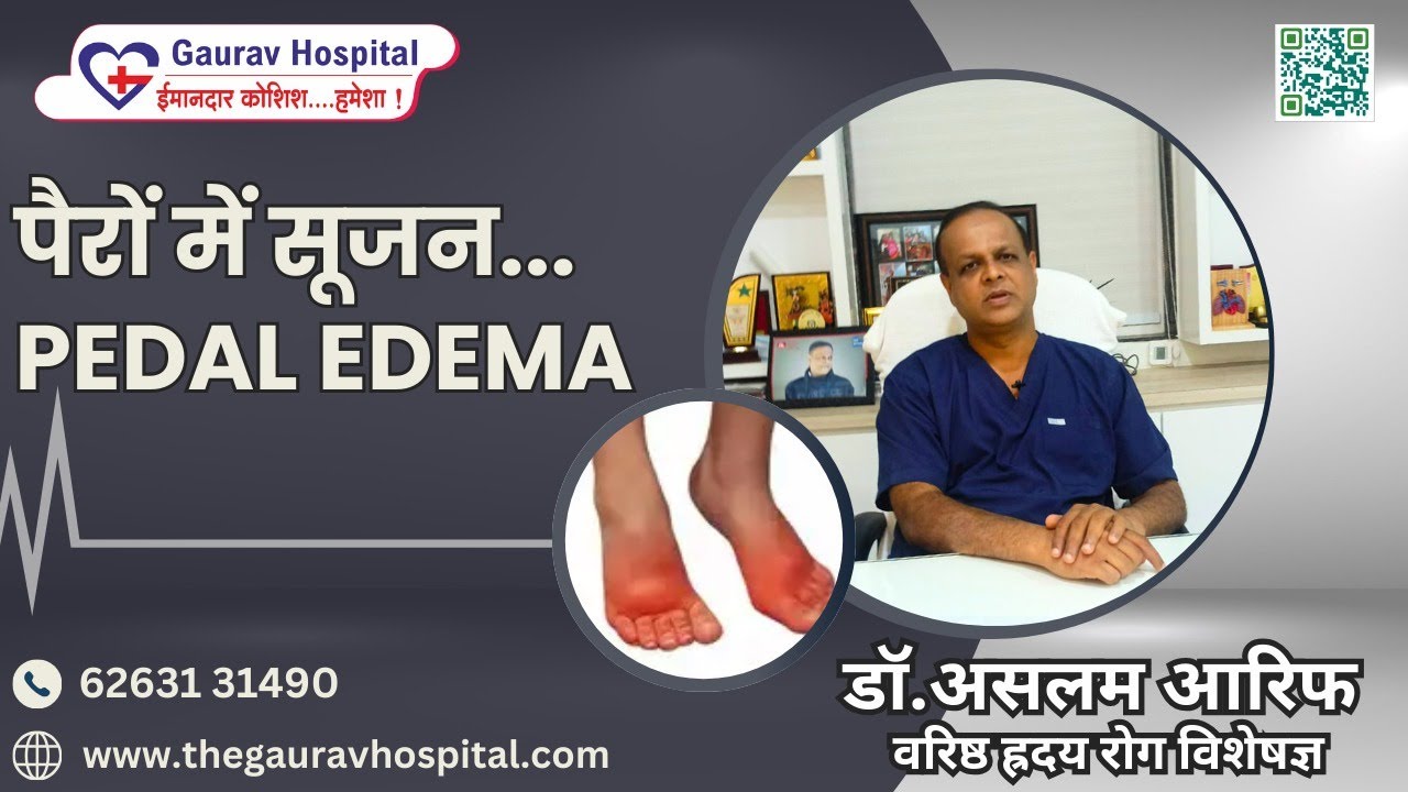 पैरों में सूजन... Pedal edema कारण एवं लक्षण | #doctor #heartdoctor # ...