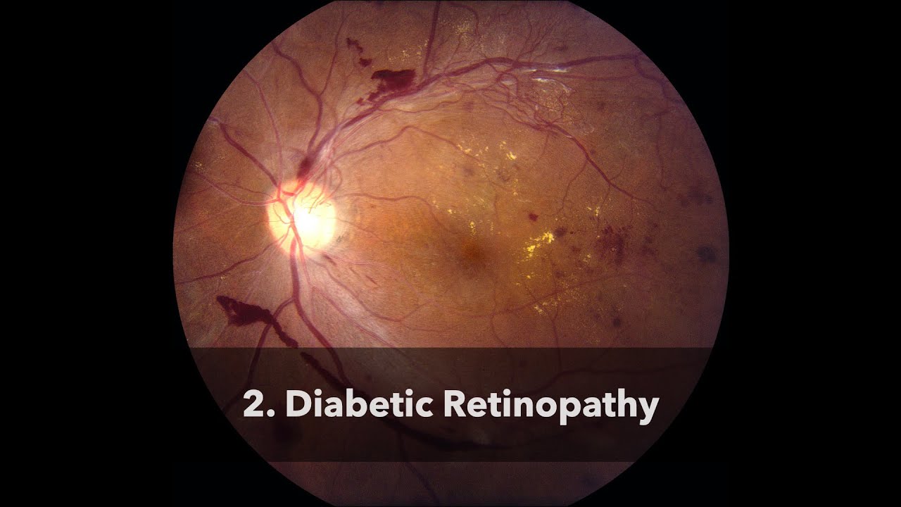 Diabetic Retinopathy - YouTube
