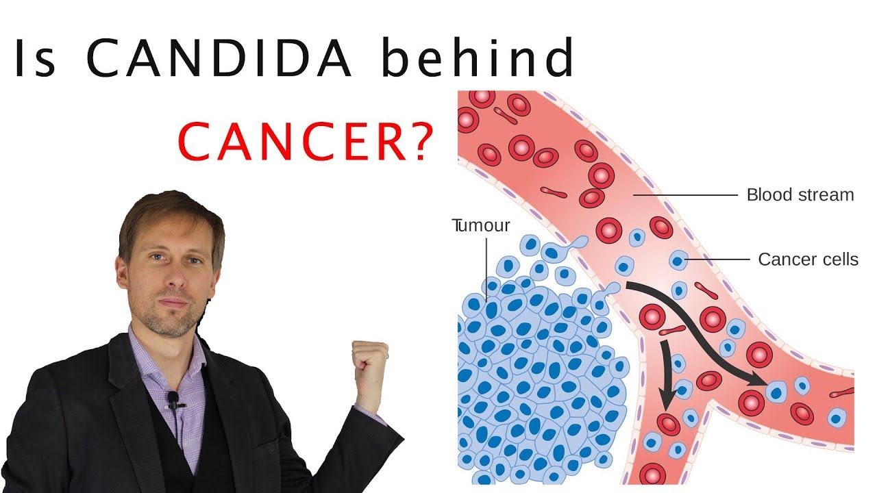 Candida cancer: what's the REAL link between the two? (DEEP ...