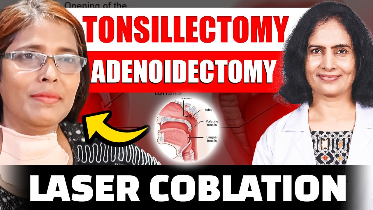 Laser Coblation Tonsillectomy and Adenoidectomy - YouTube