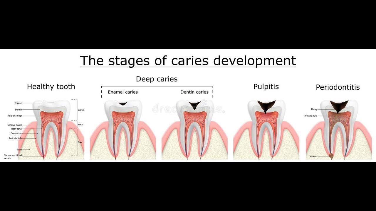 PATHOGENESE OU EVOLUTION DES CARIES DENTAIRES - YouTube
