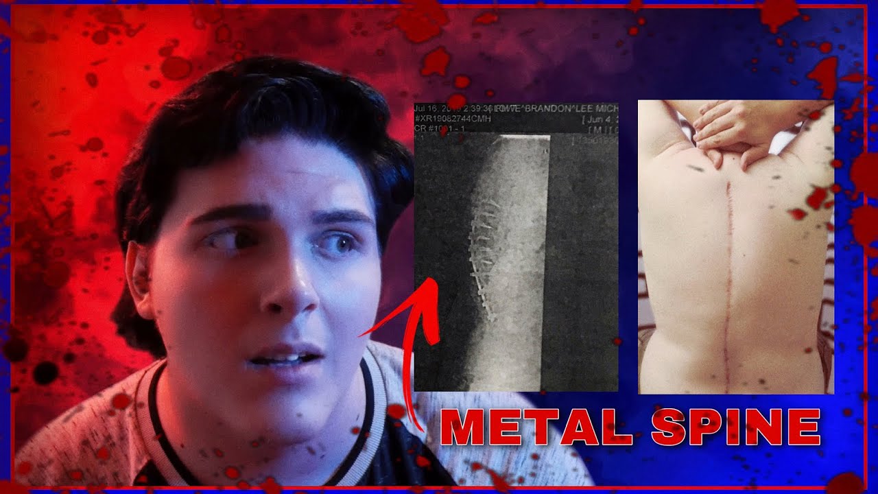 Three Years With A Metal Spine (Scoliosis, Kyphosis Surgery) - YouTube