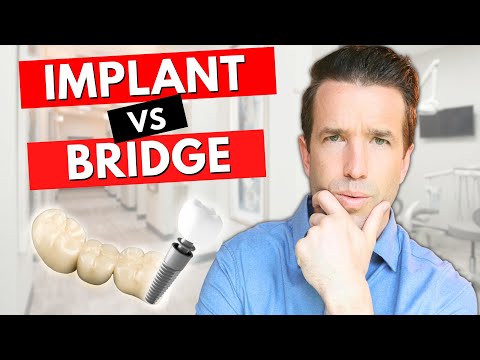 Dental Implants vs Bridges for a Missing Tooth