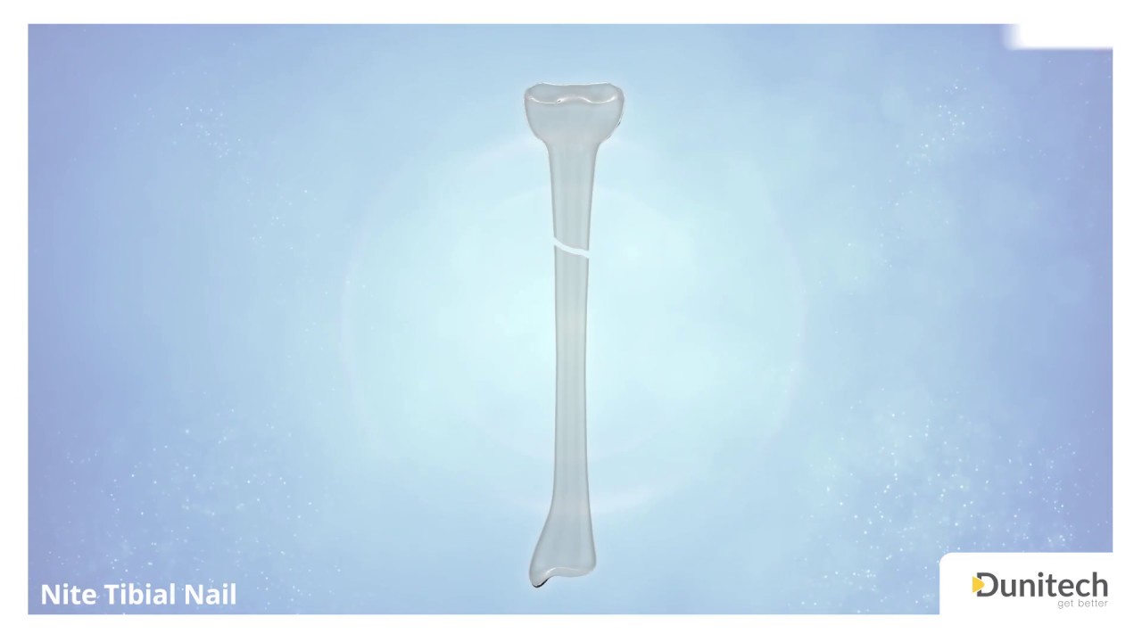 Nite Tibial Nail - YouTube
