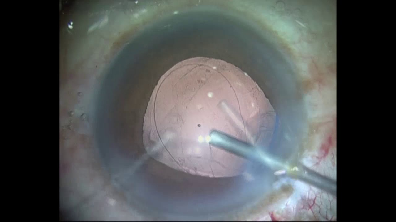 ASCRS 2012 GLUED ENDOCAPSULAR HEMI RING SEGMENTS FOR SUTURELE - YouTube