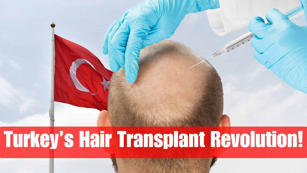 Why Turkey is the #1 Destination for Hair Transplants - YouTube