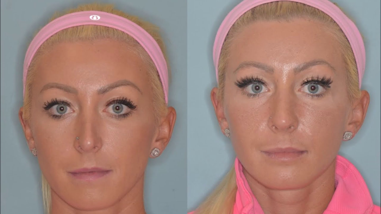 Revision Rhinoplasty For The Over Projected Nose Dr Anthony Bared Md Facs Miami Fl Youtube