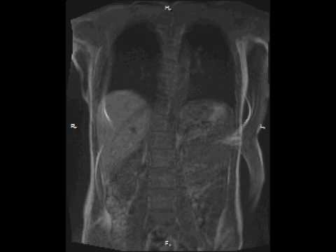 care bolus - YouTube