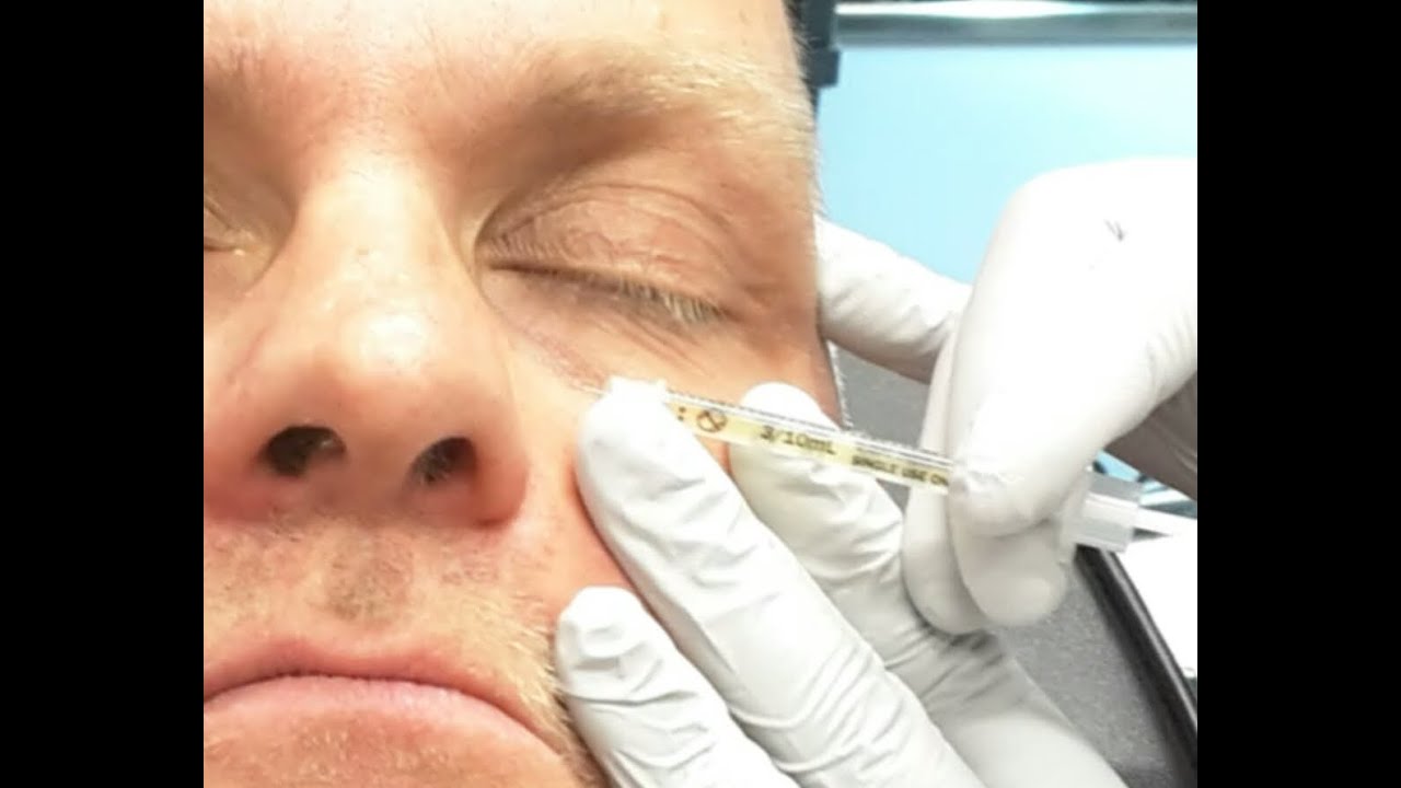 PRP Tear trough Restoration- L. Johnson, FNP, Albuquerque, NM - YouTube