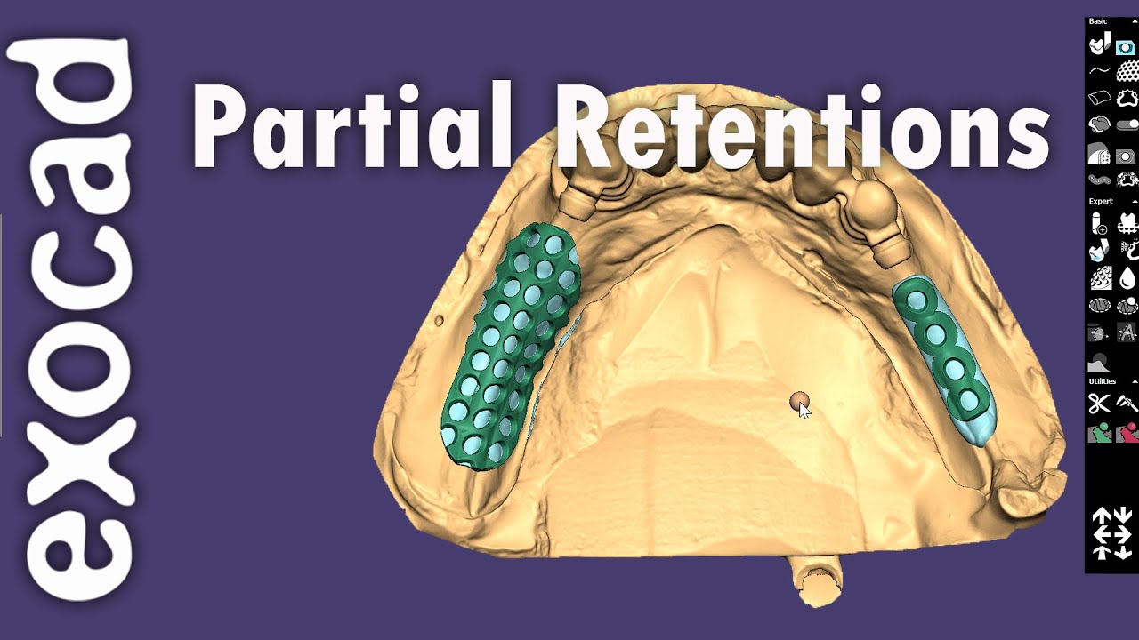 EXOCAD-Partial Retentions for the Lower Jaw - YouTube