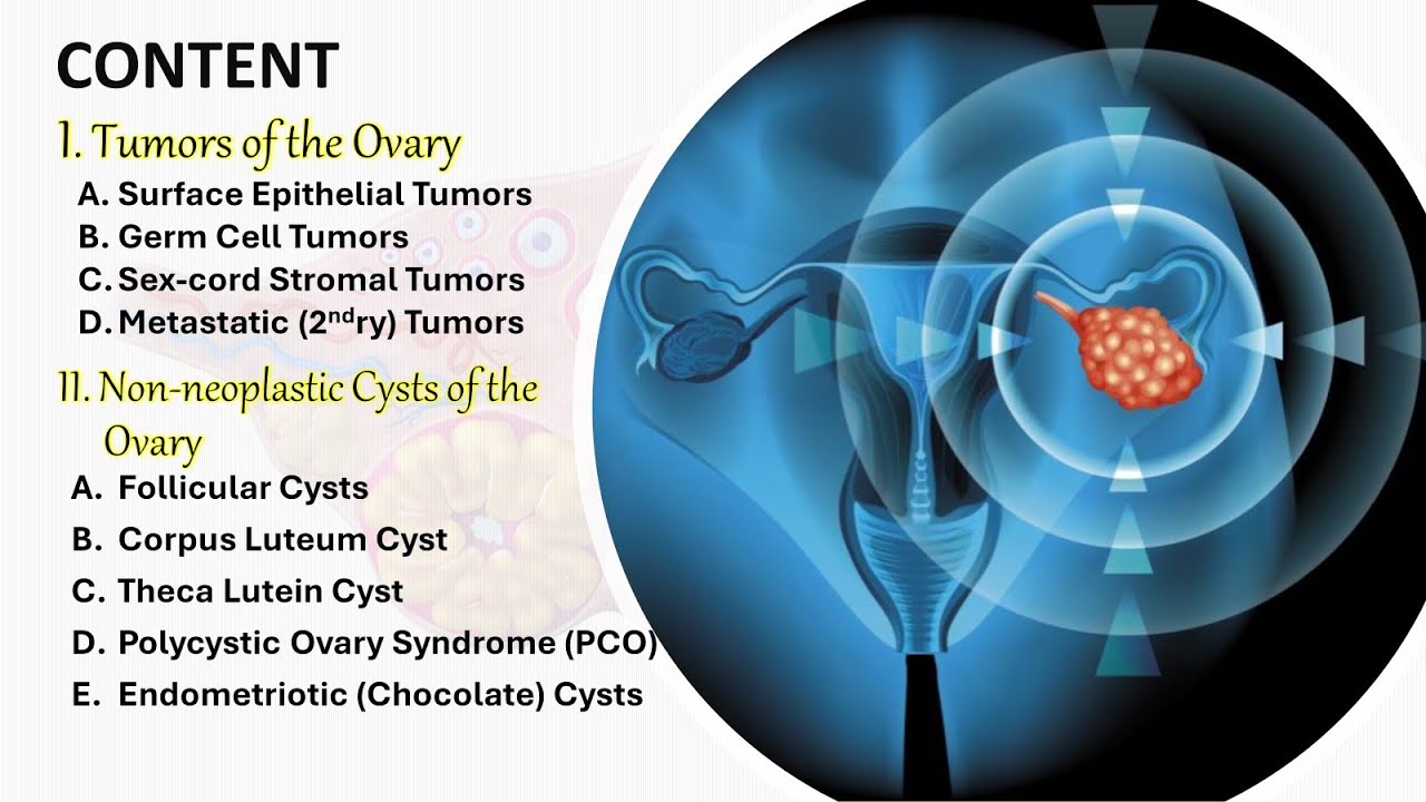 Female genital tumors part3 Ovary tumors and non-neoplastic cysts |شرح ...