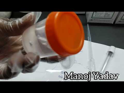 PROCEDURE OF MICROALBUMIN URINE TEST $ACR #URINE PROTEIN CREATININE ...