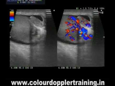 Doppler scrotum Epididymo orchitis with funniculitis mild hydrocele ...