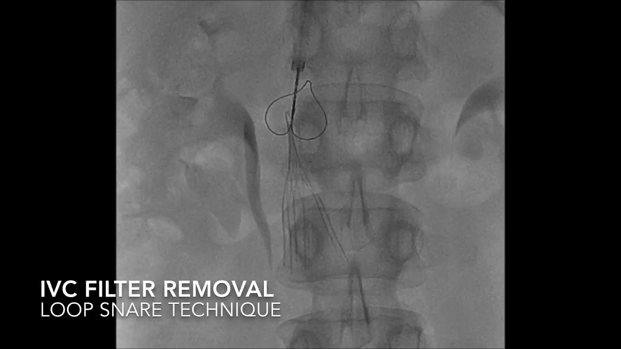 Simple IVC Filter Removal - YouTube