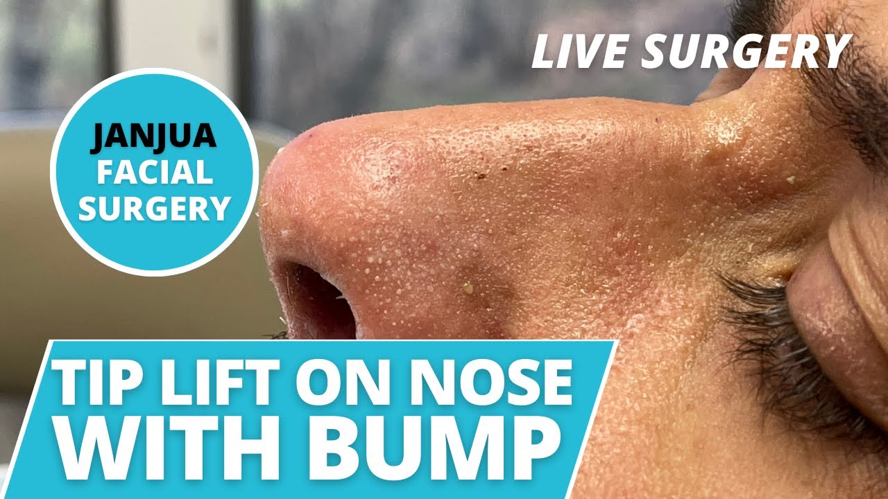 TIP LIFT ON NOSE (TLC TIP-PLASTY) - DR. TANVEER JANJUA - NEW JERSEY ...