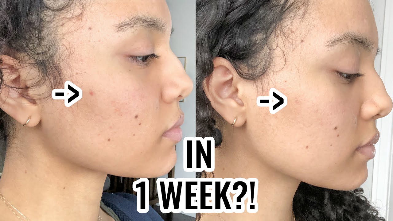 Fade Dark Spots Hyperpigmentation FAST YouTube fade-dark-spots-hyperpigmentation-fast-youtube
