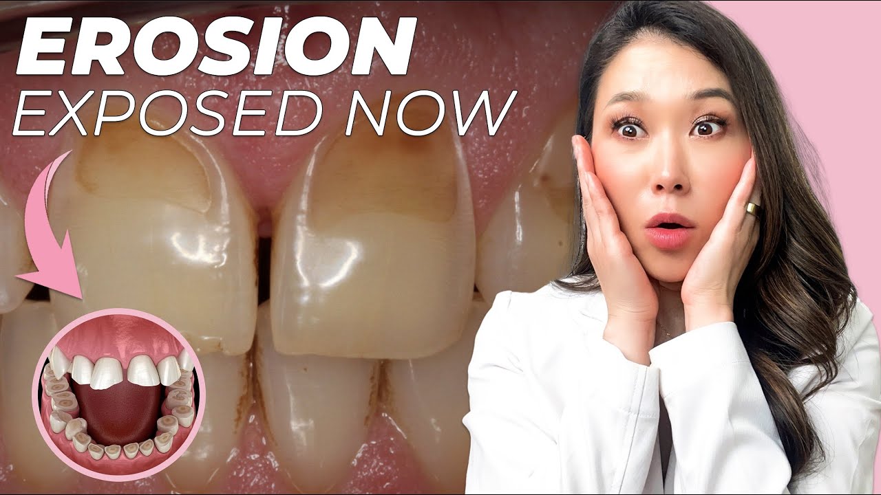 Enamel Erosion - YouTube