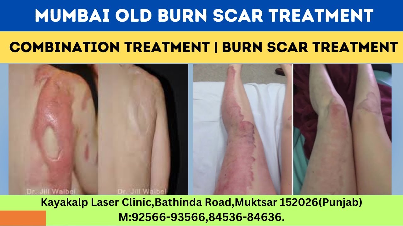 Mumbai Old Burn Scar Treatment | Combination Treatment | Burn Scar ...
