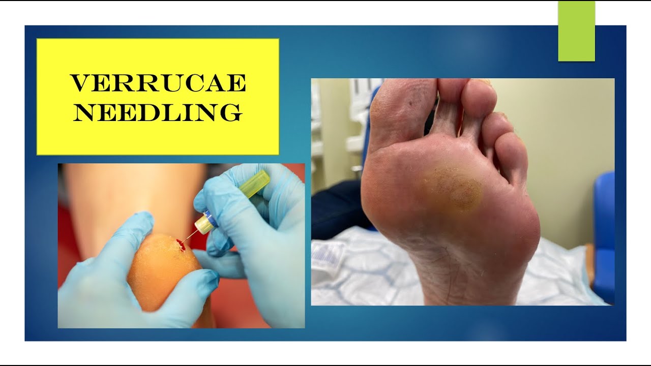 Video - verrucae needling before and after - YouTube