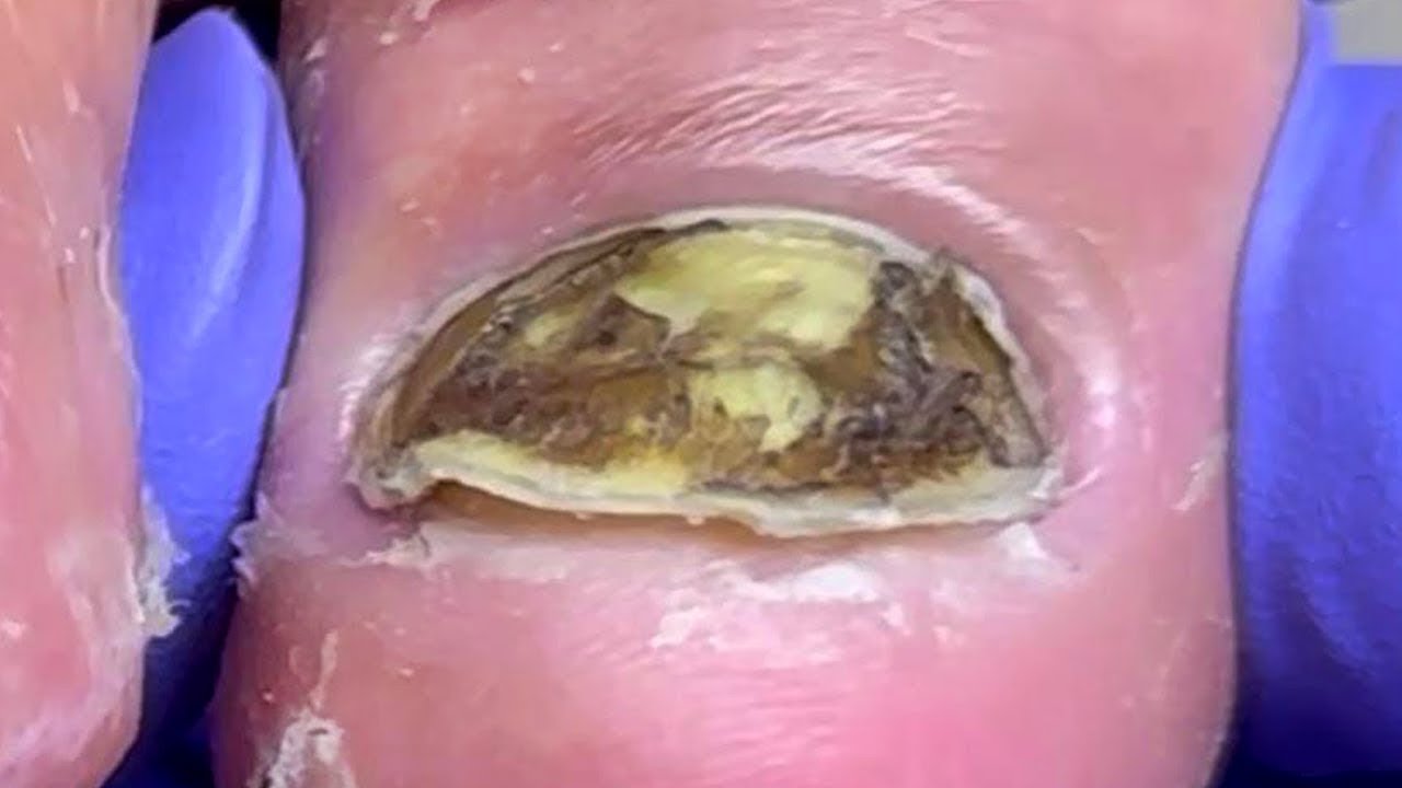 Very Rare Black Toenails That Spread To All Toes【Doctor Liu Pedicure ...