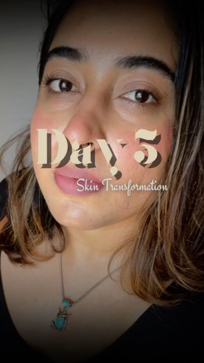 Day 3 of my 30-day skin transformation journey #skincare #weightloss #fitness #healthylifestyle ...