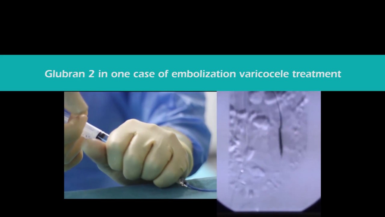 Glubran2 in a case of embolization varicocele treatment - YouTube